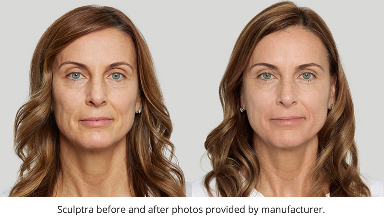 Collagen Biostimulators – Eltham Cosmetic Clinic