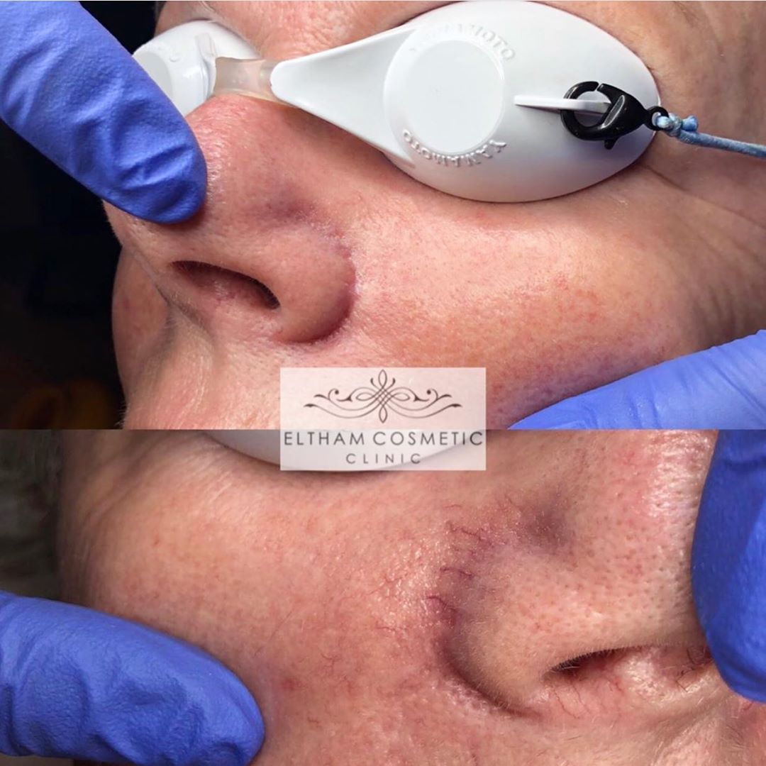 Sun Damaged Skin On Chest