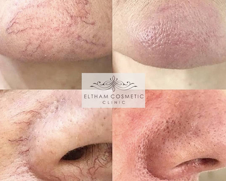 Sun Damaged Skin: Neck, Chest or Décolletage – Eltham Cosmetic Clinic