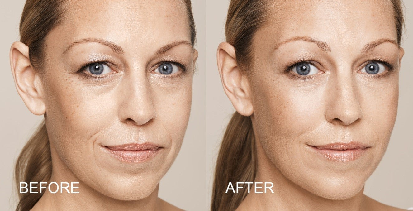 Collagen Biostimulators – Eltham Cosmetic Clinic